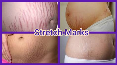 How To Remove Stretch Marks 100 Guaranteed Result Youtube