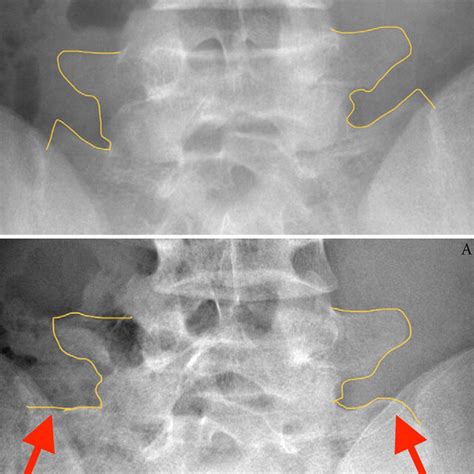 Comparison Of The Preoperative And 6 Month Postoperative Radiographs Of