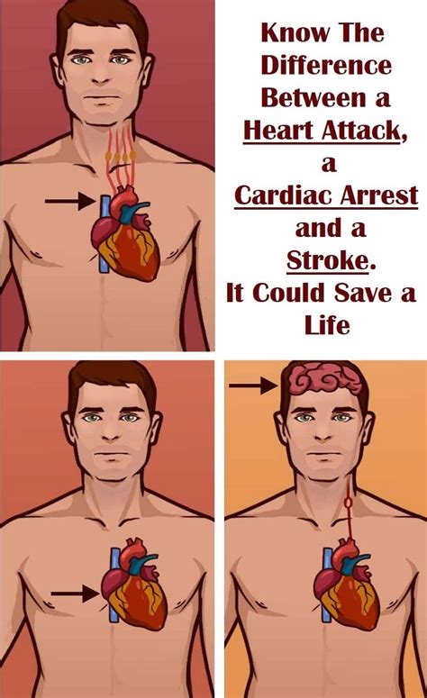Know The Difference Between A Heart Attack A Cardiac Arrest And A
