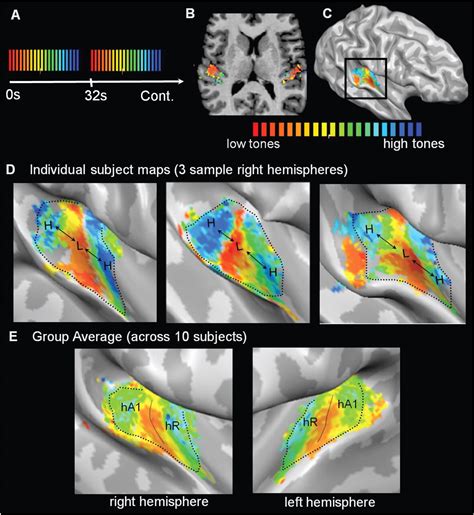 Human Primary Auditory Cortex Follows The Shape Of Heschls Gyrus