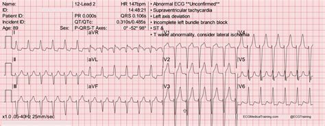How To Calculate Heart Rate In Bpm Haiper