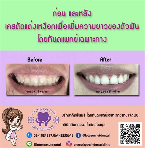 การตัดแต่งเหงือก Gingivectomy และ Gingivoplasty คลินิกทันตกรรม