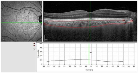 Frontiers Multimodal Retinal Imaging For Detection Of Ischemic Stroke