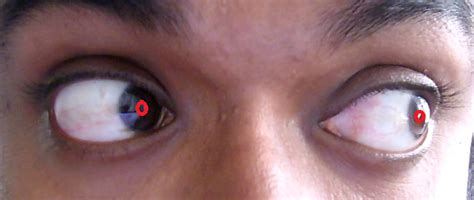 opencv find white region of eye stack overflow