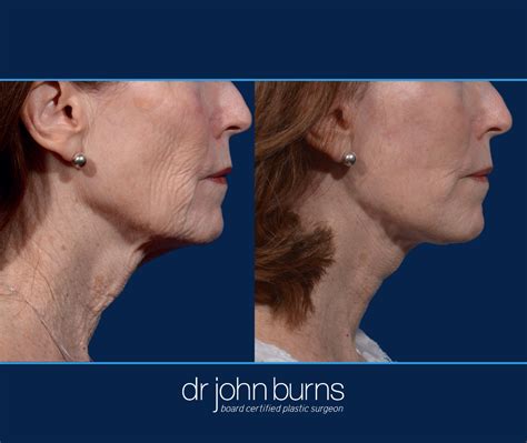 The Lift And Fill Facelift Dr John Burns Dr John Burns