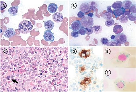 Severe Megaloblastic Anemia Vitamin Deficiency And Other Causes