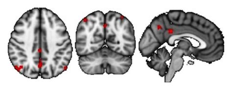 Areas Of Increased Thalamic Connectivity Posterior Cingulate Gyrus