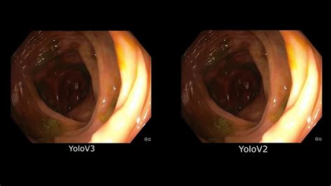 yolo v3 vs yolo v2 colonoscopy youtube