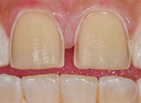 اطباء اسنان The Veneer Step By Step