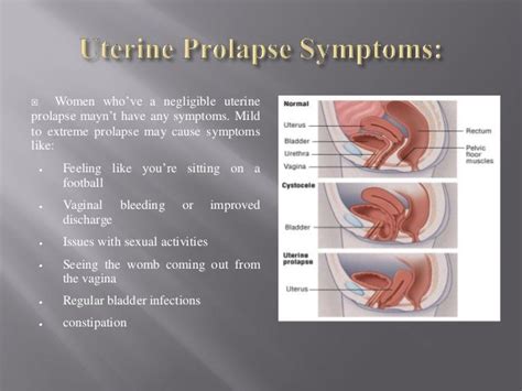 Uterine Prolapse Symptoms And Diagnosis