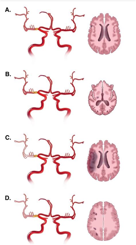 Emergent Large Vessel Occlusion Due To Intracranial Stenosis