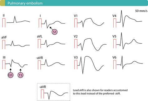 St Segment Elevation In Acute Myocardial Ischemia And Differential