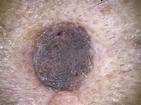 Seborrheic Keratosis Dermoscopy Stock Image C056 3230 Science