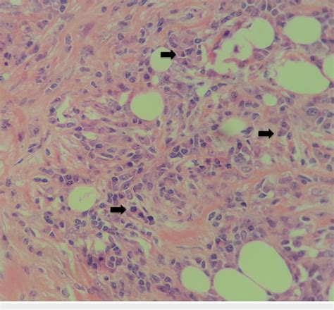 Adipose Tissue Fibroblasts And Plasmocytes Arrow Hande 40x Hande
