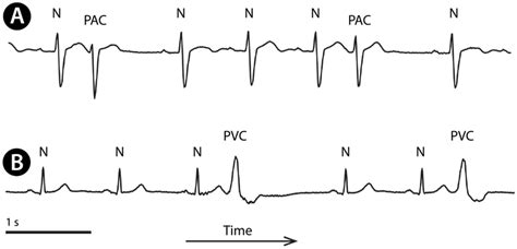Examples Of Ecg Signal With The Most Common Qrs Types Normal Sinus