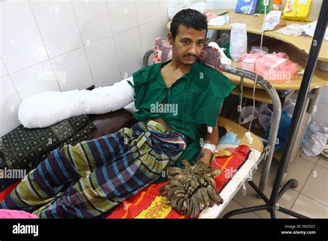 Bangladeshi Tree Man Abdul Bajander Rests After A Surgery At Dhaka