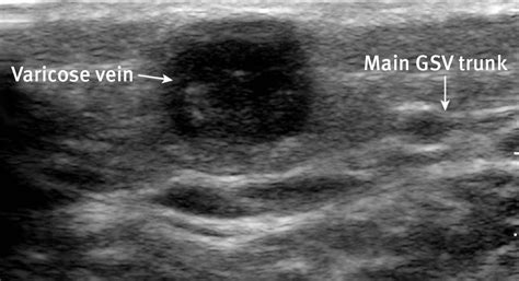 Superficial Thrombophlebitis Superficial Venous Thrombosis The Bmj