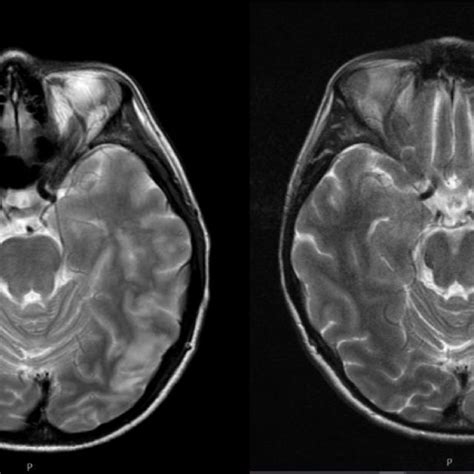 T2 Weighted Magnetic Resonance Imaging Demonstrating Partial Resolution