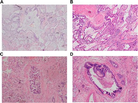 Frontiers Small Airway Dysfunction In Idiopathic Pulmonary Fibrosis