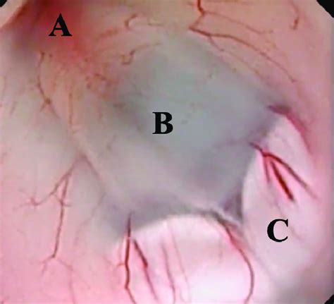 Endoscopic View Of The Third Ventricle Showing Infundibular Recess A