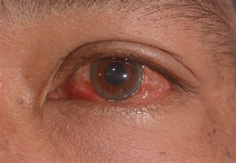Conjuntivitis Vírica Tratamiento Eficaz Área Oftalmológica