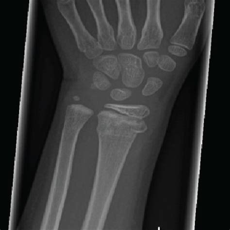 A B Anteroposterior And Lateral Radiographs Of The Left Wrist Distal