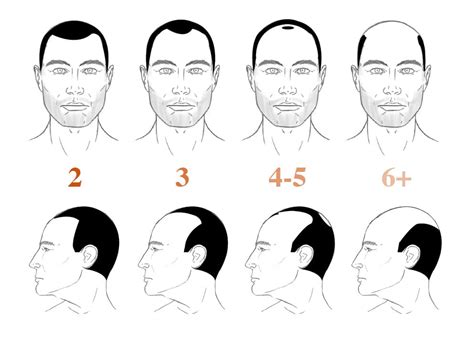 Norwood 2 Hairline Causes And Treatments Hairguard
