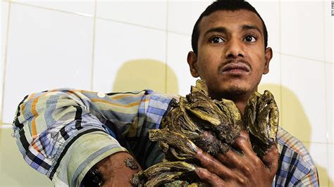 Bangladeshs Tree Man To Have Surgery Cnn