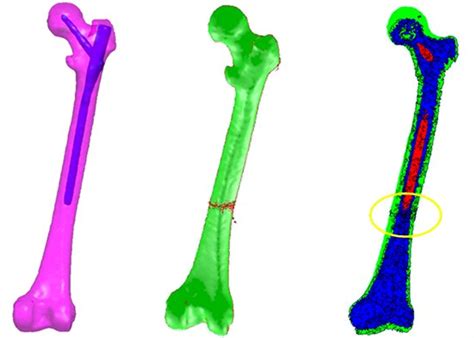 Finite Element Analysis Modelling Of Proximal Femoral Fractures
