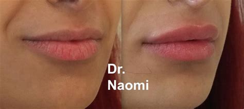 Lip Fillers Sydney Lip Injections By Our Expert Doctors Dermal Fillers