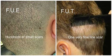Fue Vs Fut Hair Transplant Specialist