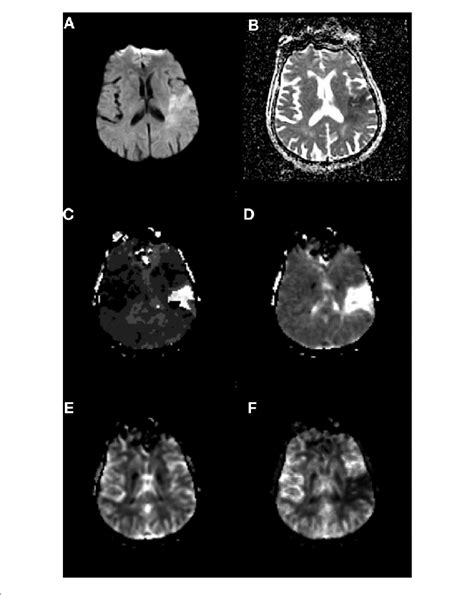 Perfusion Diffusion Mismatch To Identify Salvageable Tissue A