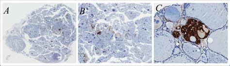 A Case Of C Cell Hyperplasia In An Asymptomatic V804m Ret Mutation