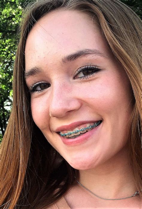 Braces Girls Cute Braces Teeth Whitening Uk Activated Charcoal Teeth