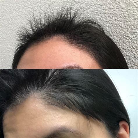 For Anyone Also Going Through Postpartum Hair Loss — Dont Lose Hope I