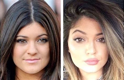 Kylie Jenners Plastic Surgery The Width Of Her Jaw Has Decreased