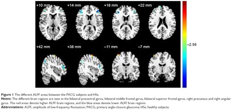 [full text] disturbed spontaneous brain activity pattern in patients