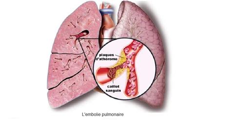 Lembolie Pulmonaire Physiopathologie Symptômes Pronostic Et