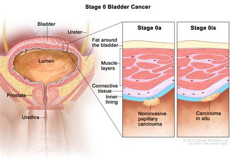 [table] Table 1 Definitions Of Tnm Stages 0 And 0isa Pdq Cancer
