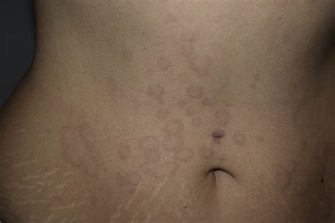 Primary Anetoderma In A Woman After Ovarian Stimulations For In Vitro