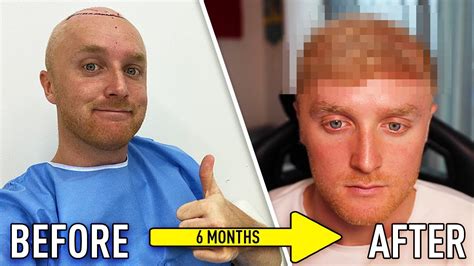 My 6 Month Hair Transplant Results Before And After Youtube