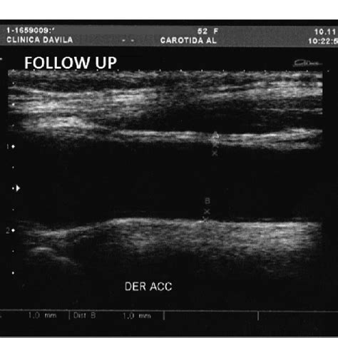 Ultrasound Of Carotid Intima Media Thickness Two Of Twelve Measures