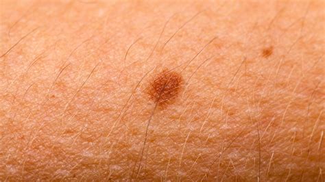 New Hair Loss Treatments May Be On The Way After Major Discovery