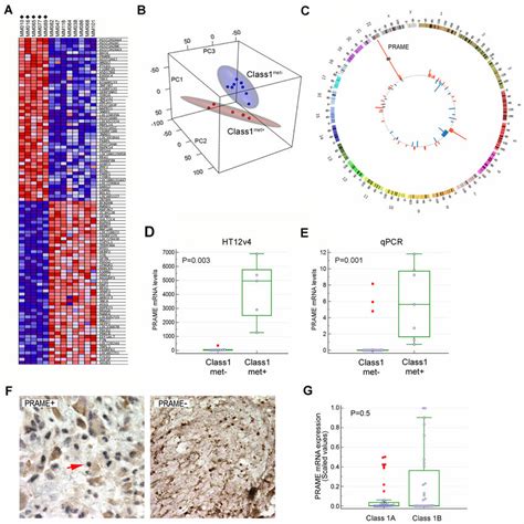 Gene Expression Profiling Of Class 1 Primary Uveal Melanomas Based On