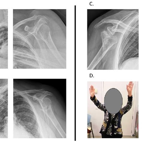 Neers Classification Of Proximal Humeral Fractures Modified From Neer
