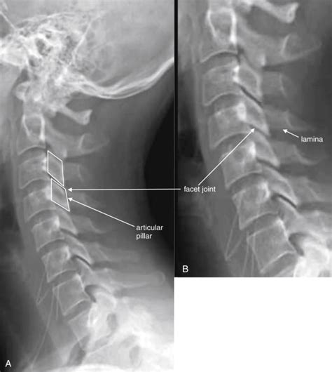 Imaging The Cervical Thoracic And Lumbar Spine Radiology Key