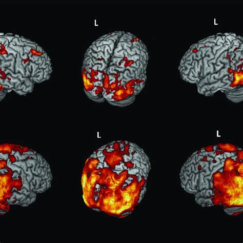 Voxel Based Morphometry And Voxel Based Metabolism Results Showing