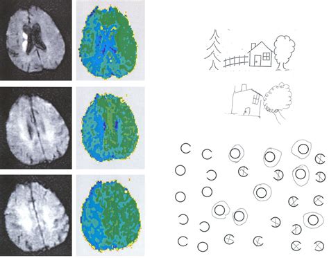 Anatomy Of Spatial Attention Insights From Perfusion Imaging And