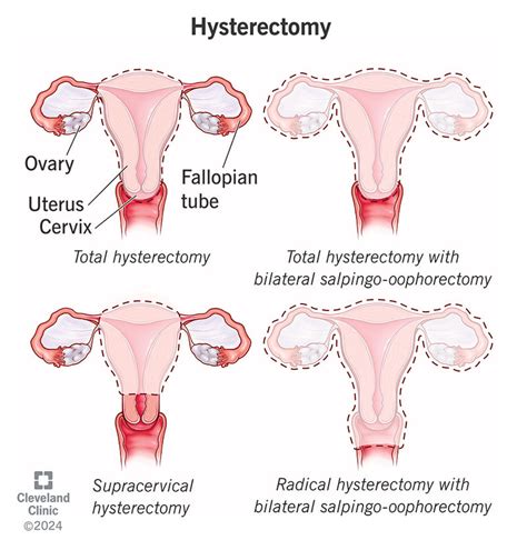 Benefits Of Hysterectomy For Fibroids