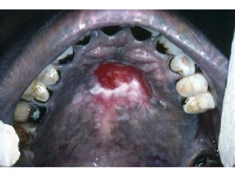 a digital manual for the early diagnosis of oral neoplasia